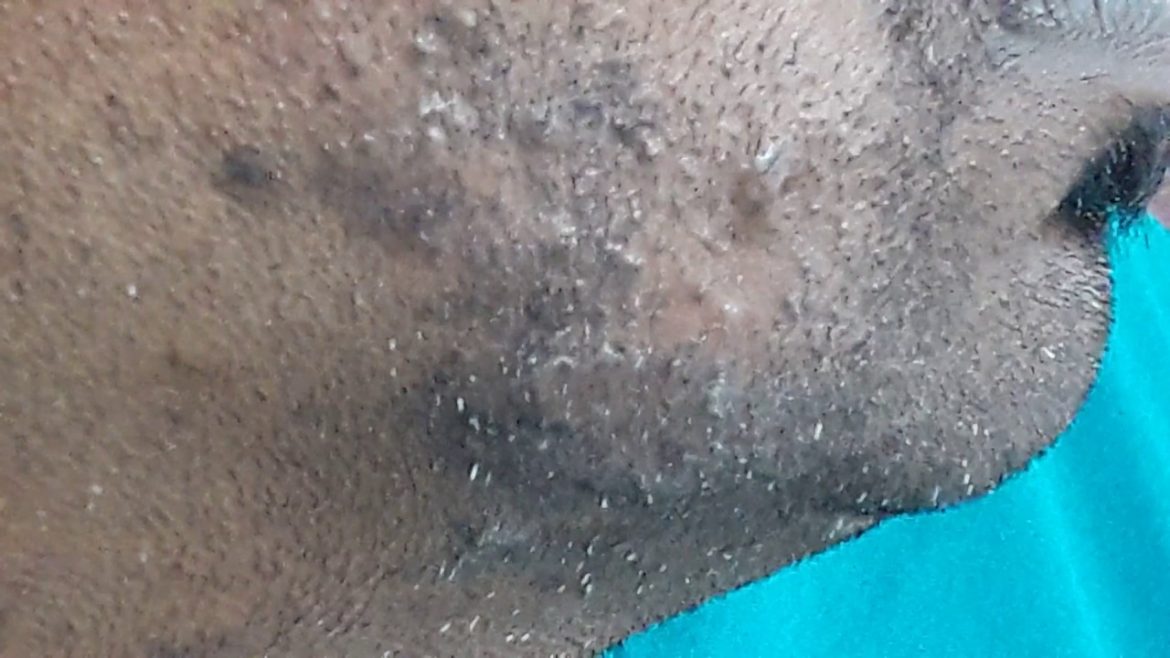 Sycosis Barbae Treatment And Prevention – My Beard Gang